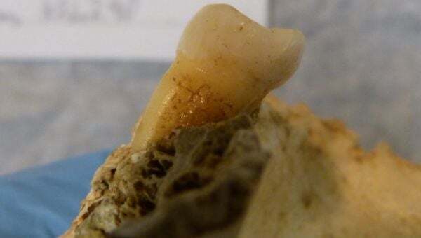 Evidence of tooth decay-causing bacteria found in 4,000-year-old human ...